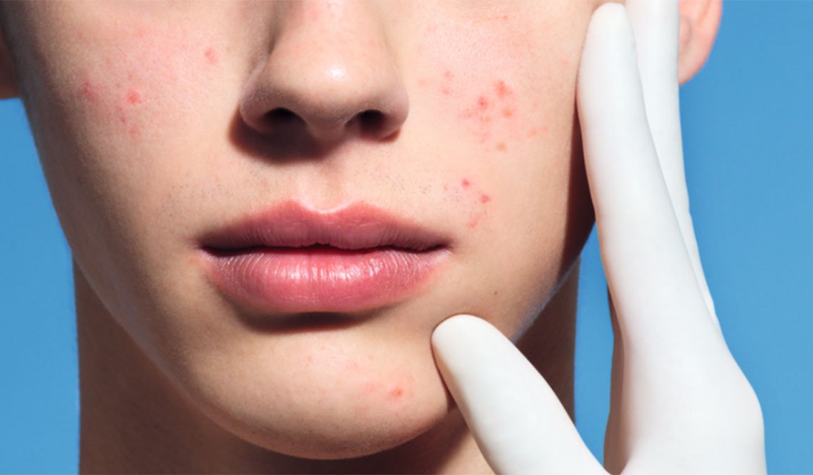 Acne: causas, tratamentos e produtos | La Roche-Posay